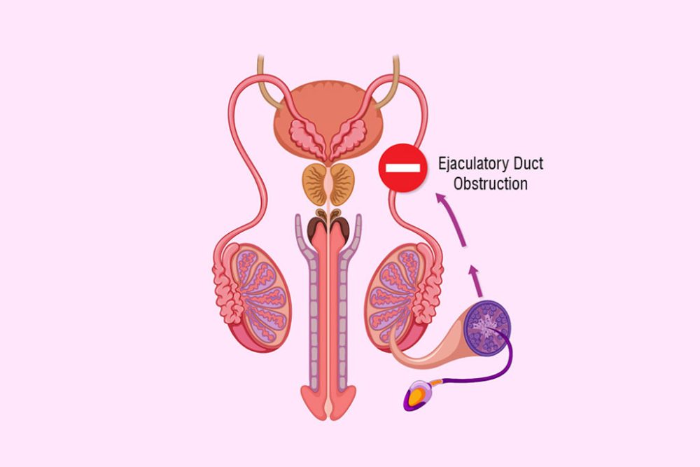 Ejaculatory Duct Obstruction - Doctency.com