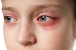 Eyelid Dermatitis - Understanding, Diagnosing, and Managing This Common ...