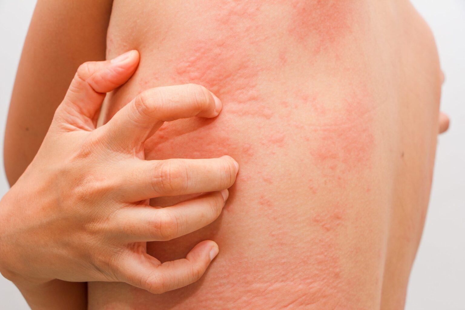 Cold Urticaria - Understanding This Rare Cold-Induced Allergy