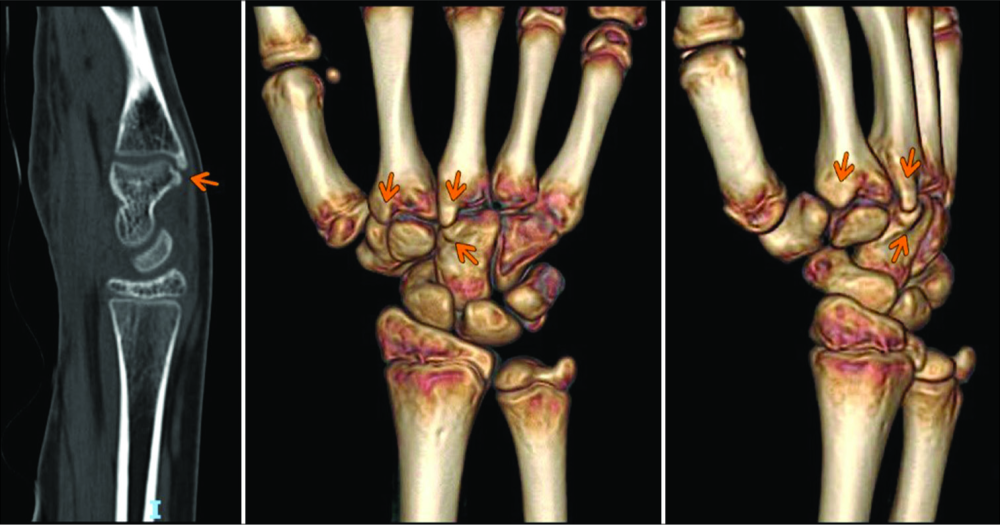 Carpal Boss - Understanding a Common Wrist Condition
