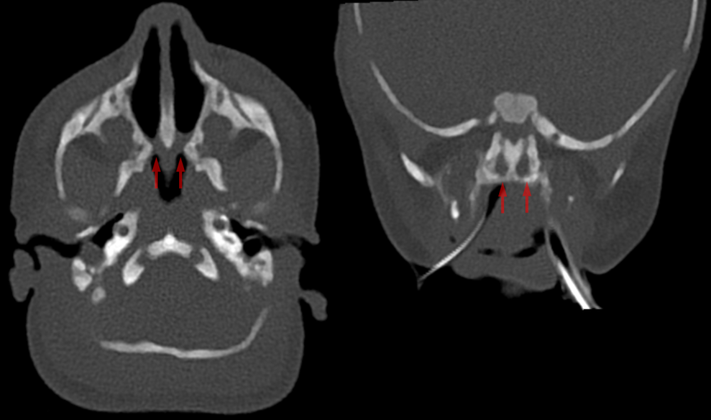 Choanal Atresia - Understanding a Congenital Nasal Condition