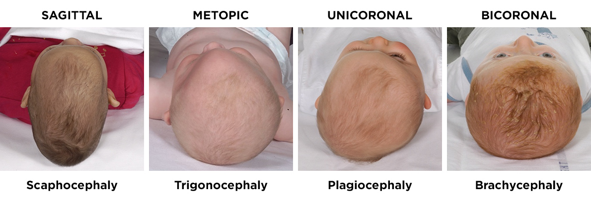Craniosynostosis - Causes, Symptoms, and Treatment