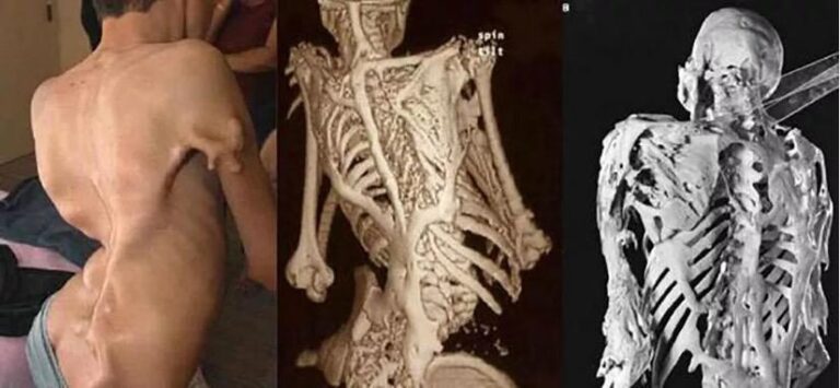 Fibrodysplasia Ossificans Progressiva - Doctency.com