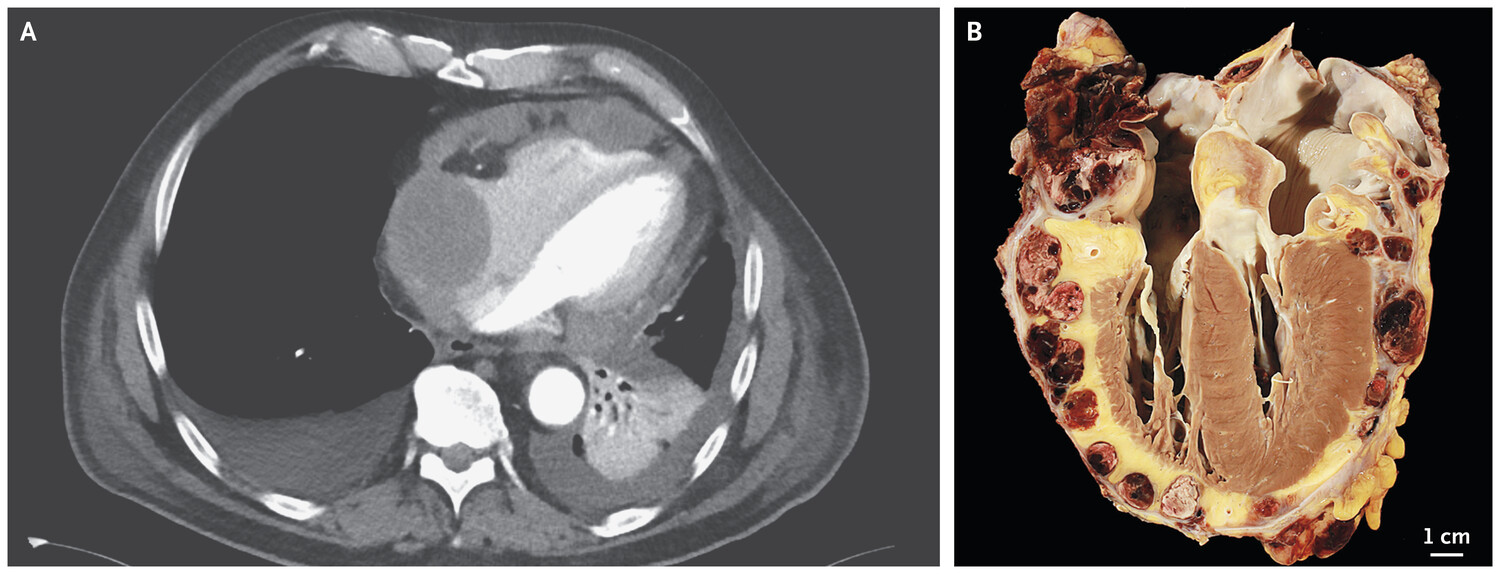 Cardiac Angiosarcoma - Understanding a Rare and Aggressive Heart Tumor