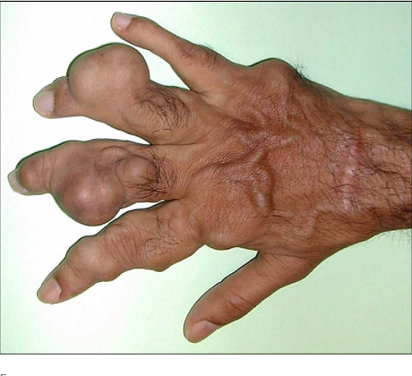 Maffucci Syndrome - Causes, Symptoms, and Treatment Options