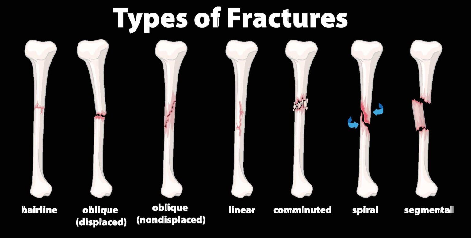 Oblique Fracture - Overview of a Common Bone Injury