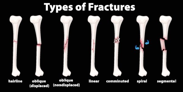 Oblique Fracture - Overview of a Common Bone Injury