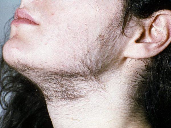 Hirsutism - Understanding Excessive Hair Growth in Women