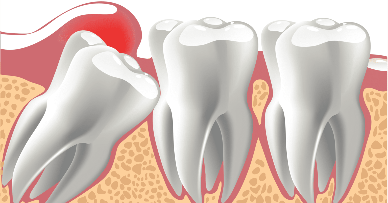 Impacted Tooth - Causes, Symptoms, and Treatments