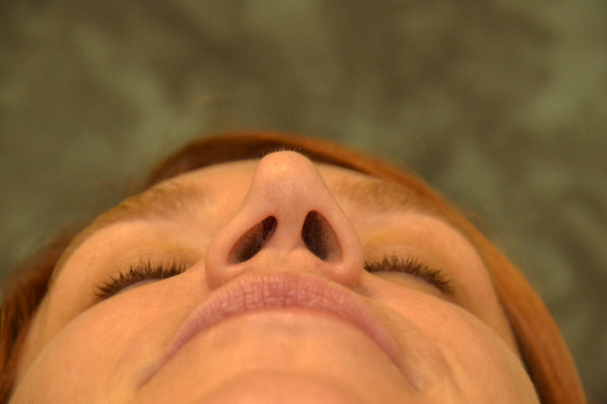 Nasal Valve Collapse - Causes, Symptoms, and Treatment