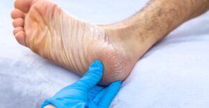 Heel Fat Pad Syndrome - Causes, Symptoms, and Management