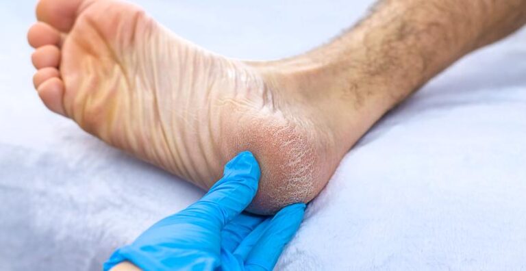 Heel Fat Pad Syndrome - Causes, Symptoms, and Management