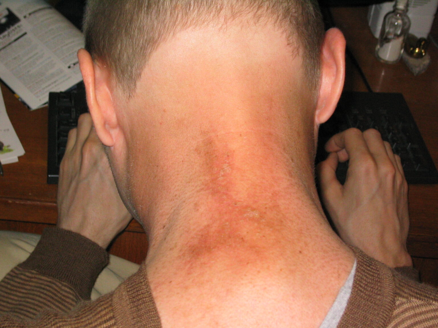 Radiation Burn - Understanding, Treatment, and Prevention