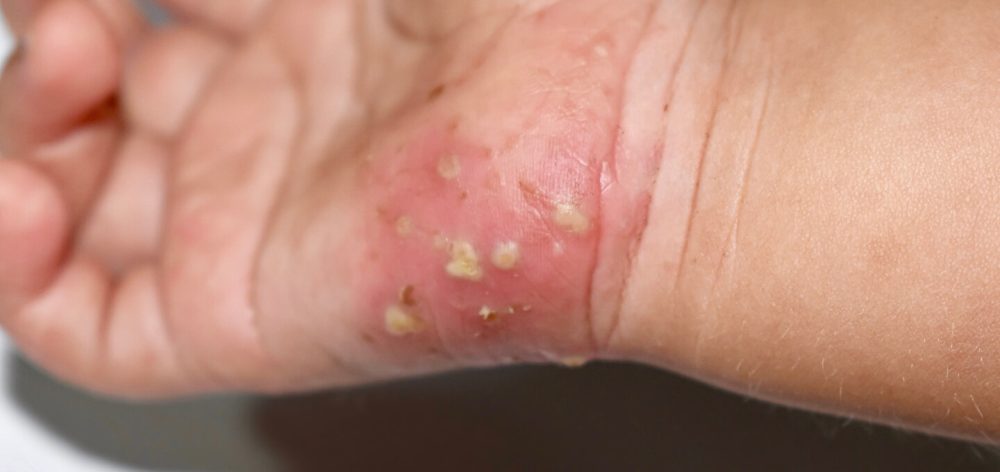 Scabies - Causes, Symptoms, and Treatment Options