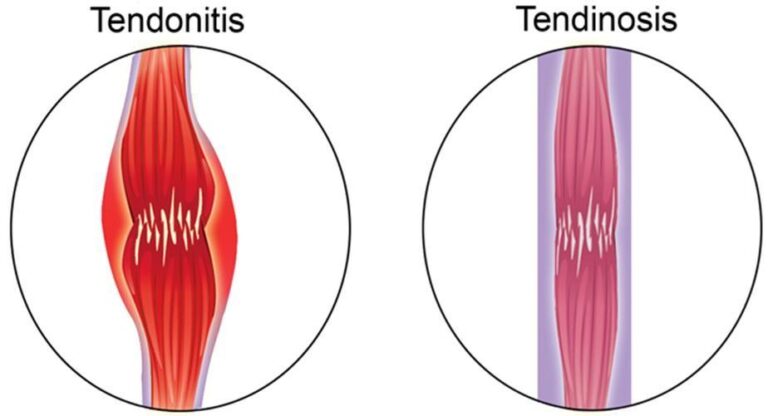 Tendonitis - Causes, Symptoms, and Treatment Options